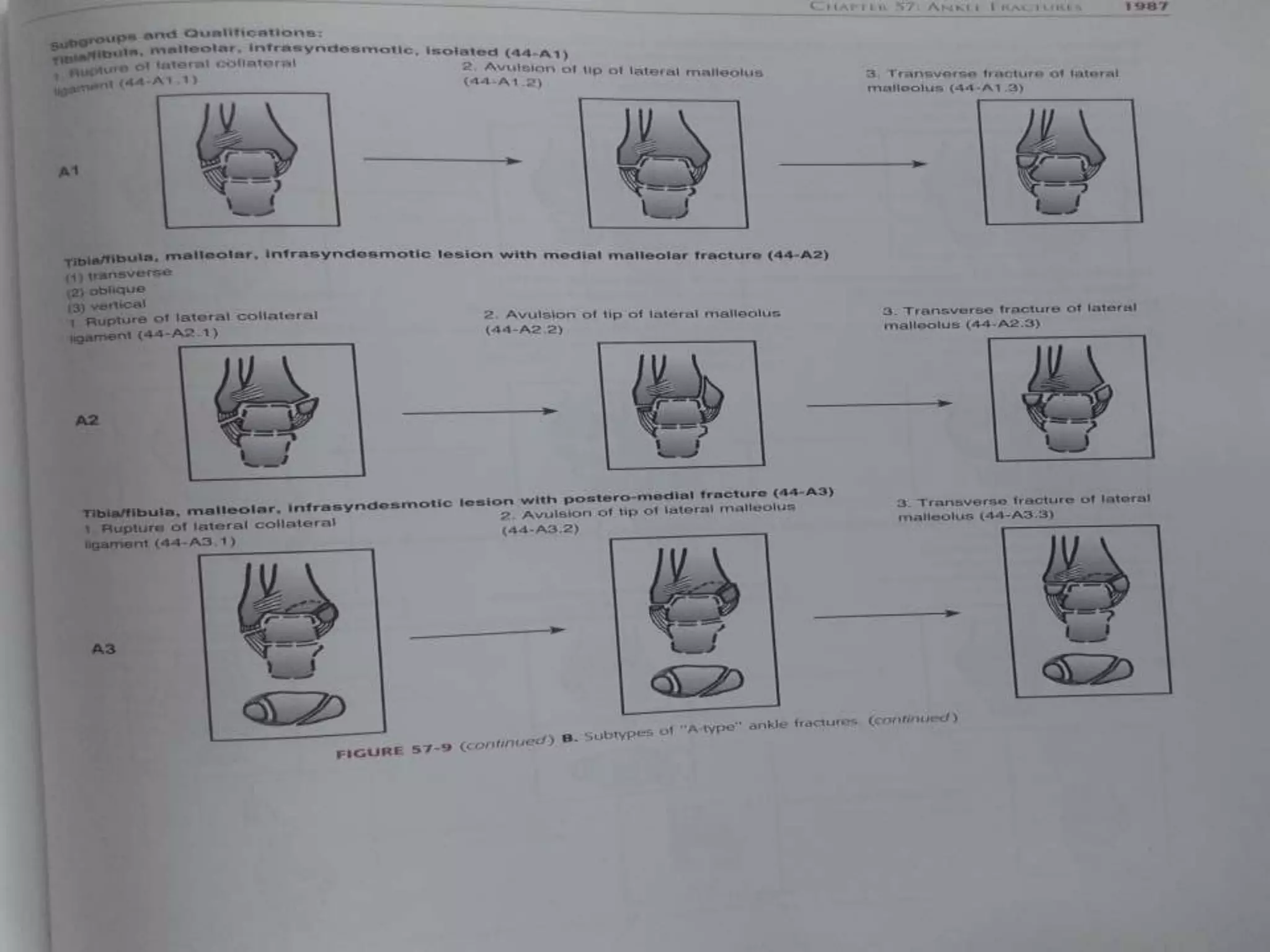 Pott’s fracture | PPTX