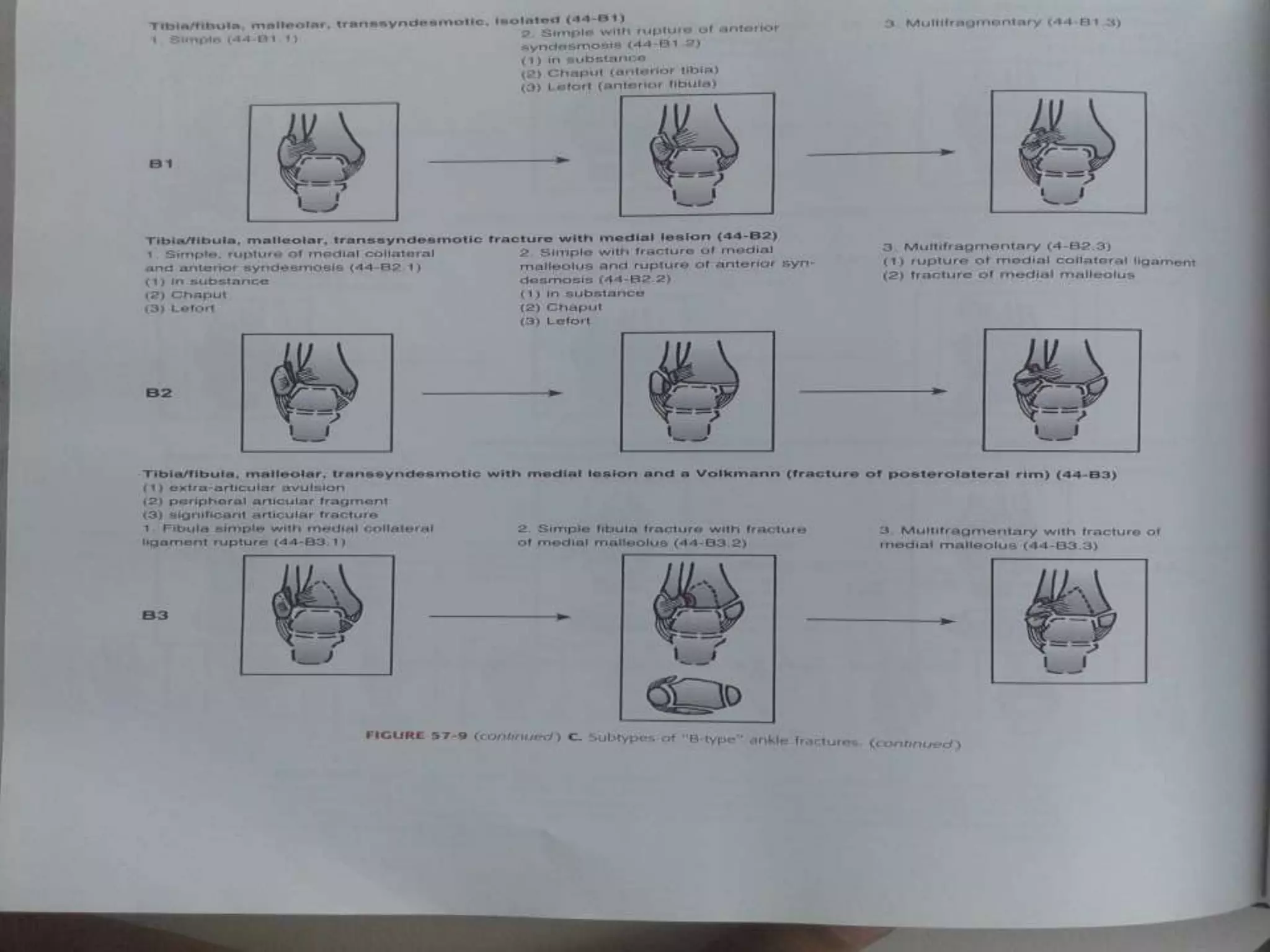 Pott’s fracture | PPTX