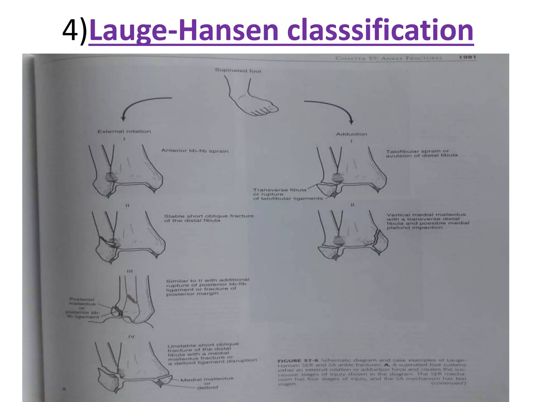Pott’s fracture | PPTX