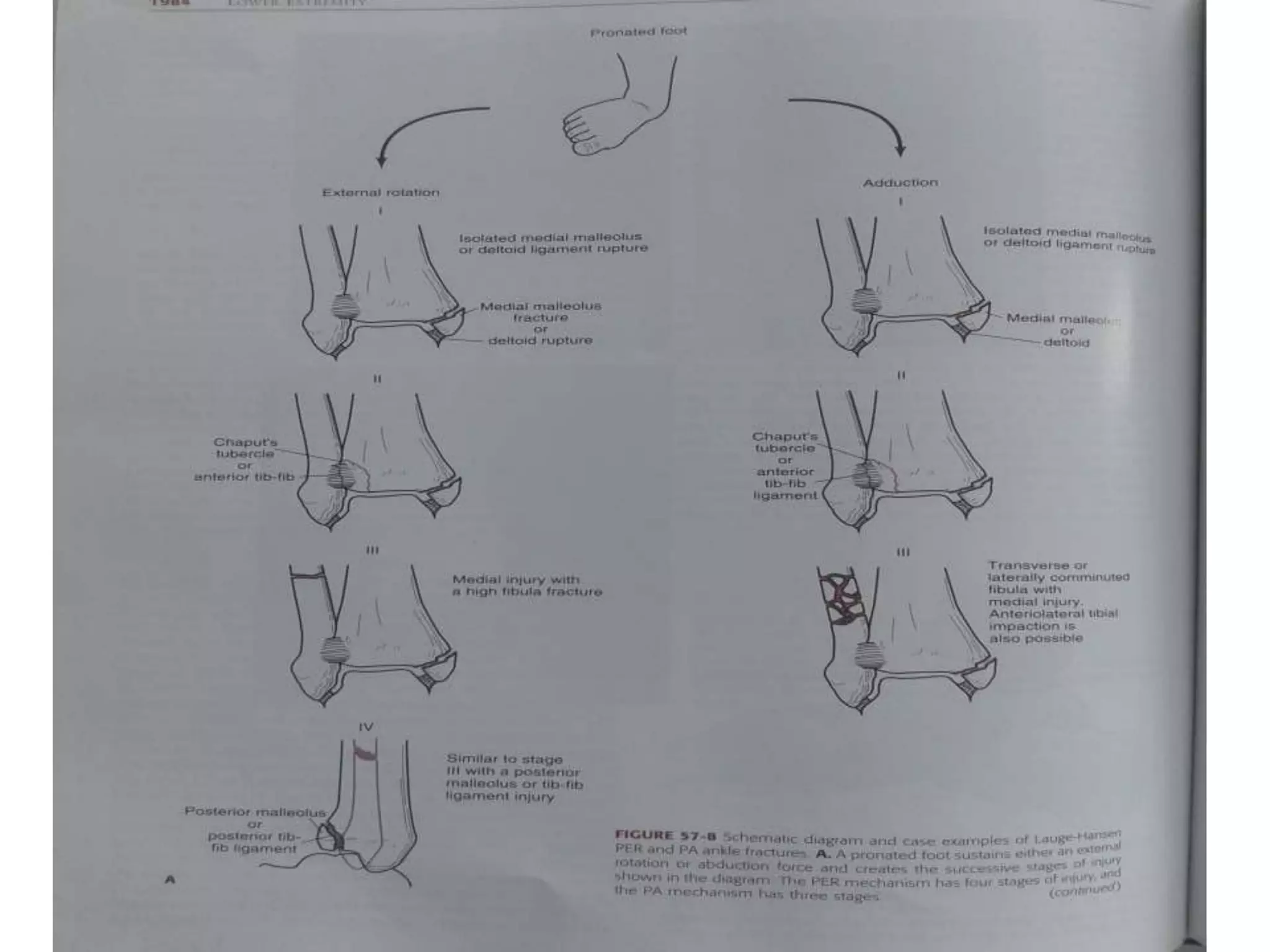 Pott’s fracture | PPTX