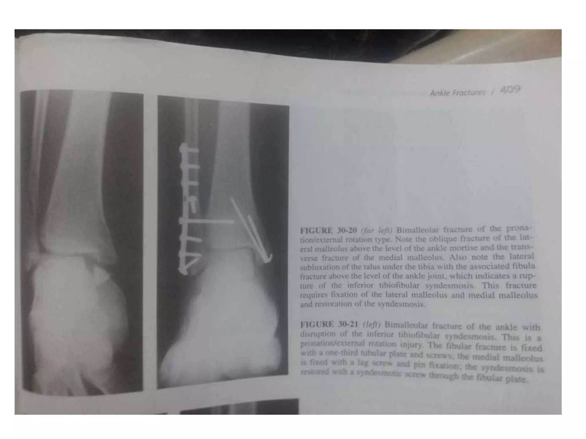 Pott’s fracture | PPTX