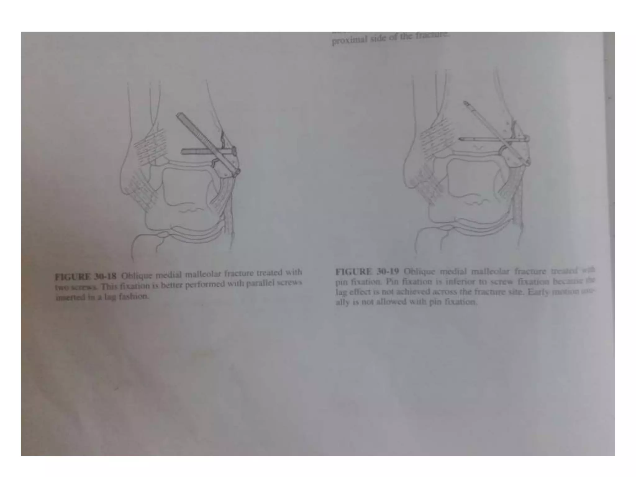 Pott’s fracture | PPTX