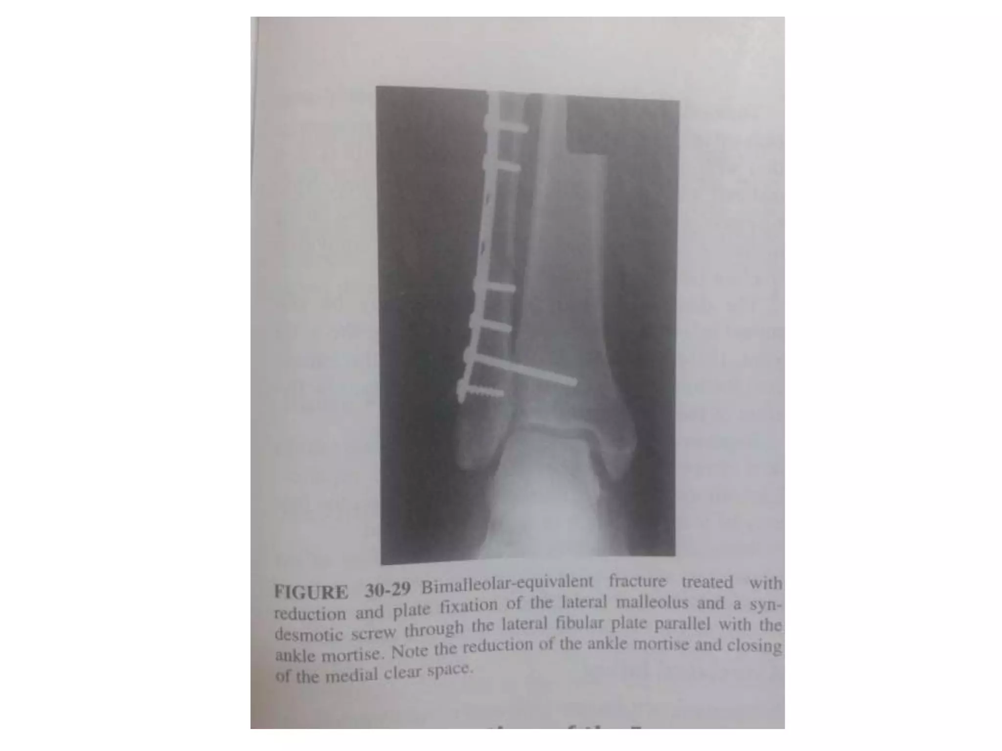 Pott’s fracture | PPTX
