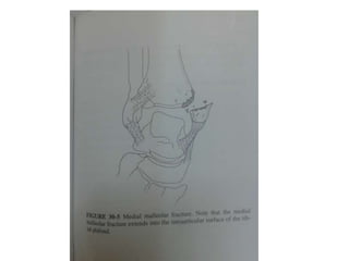 Pott’s fracture | PPTX