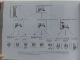 Pott’s fracture | PPTX
