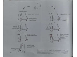Pott’s fracture | PPTX