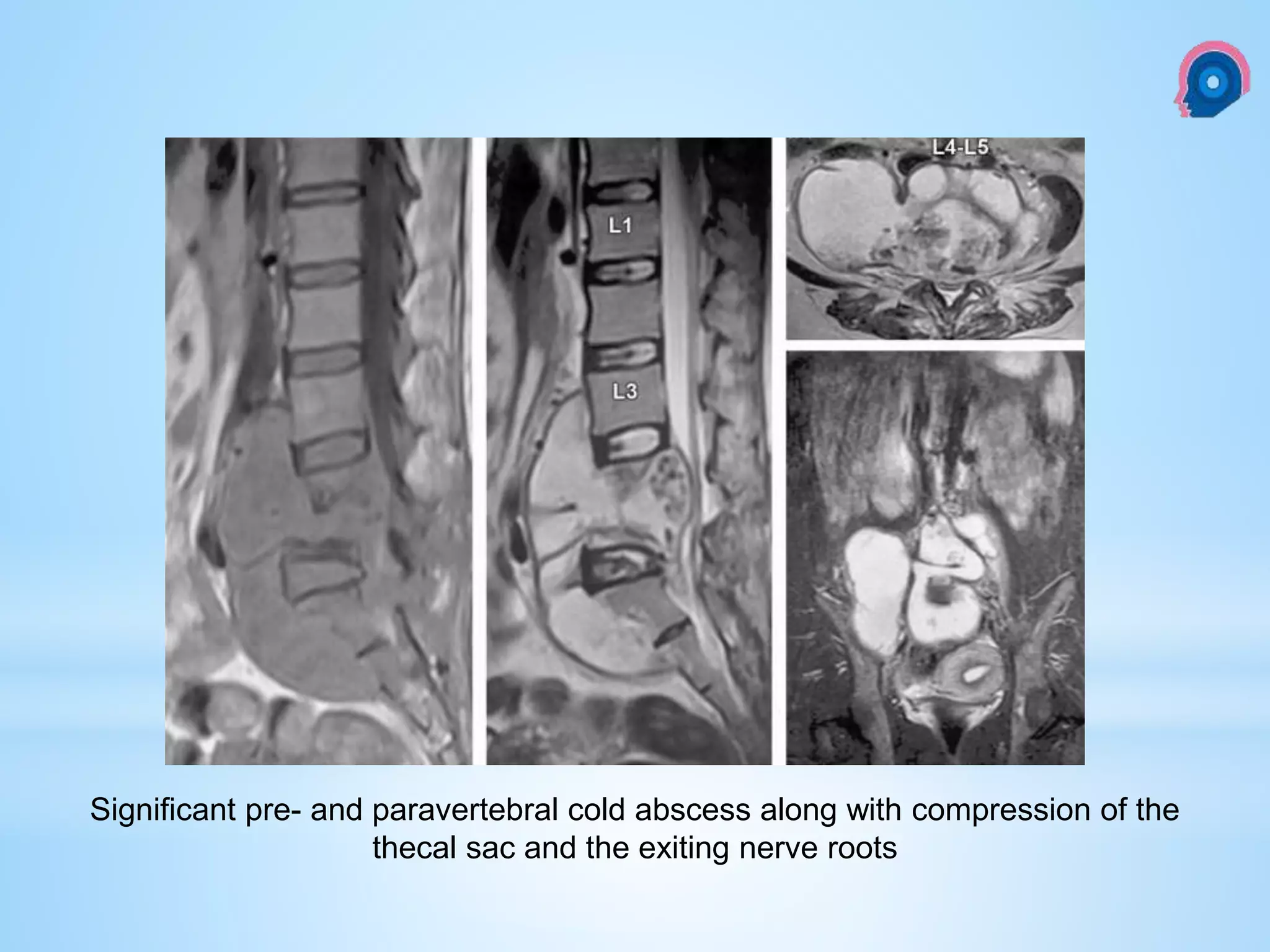 Potts spine- TB spine. | PPTX