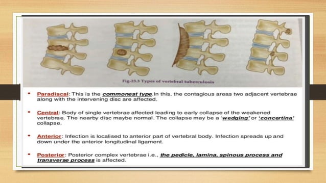 POTTS SPINE.pdf | Physical Therapy | Wellness