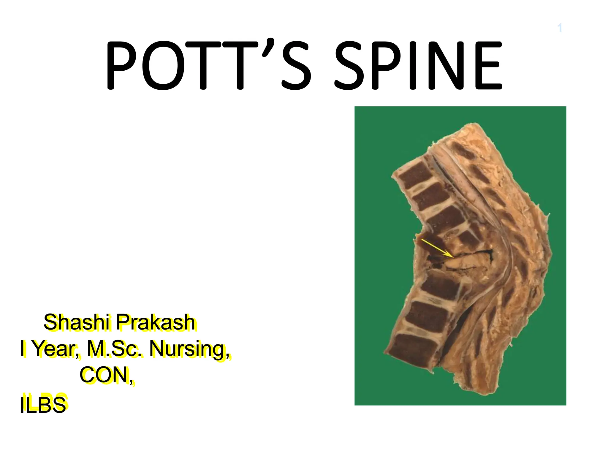 Pott's Spine. (Tuberculosis Spine) pptx | PPTX