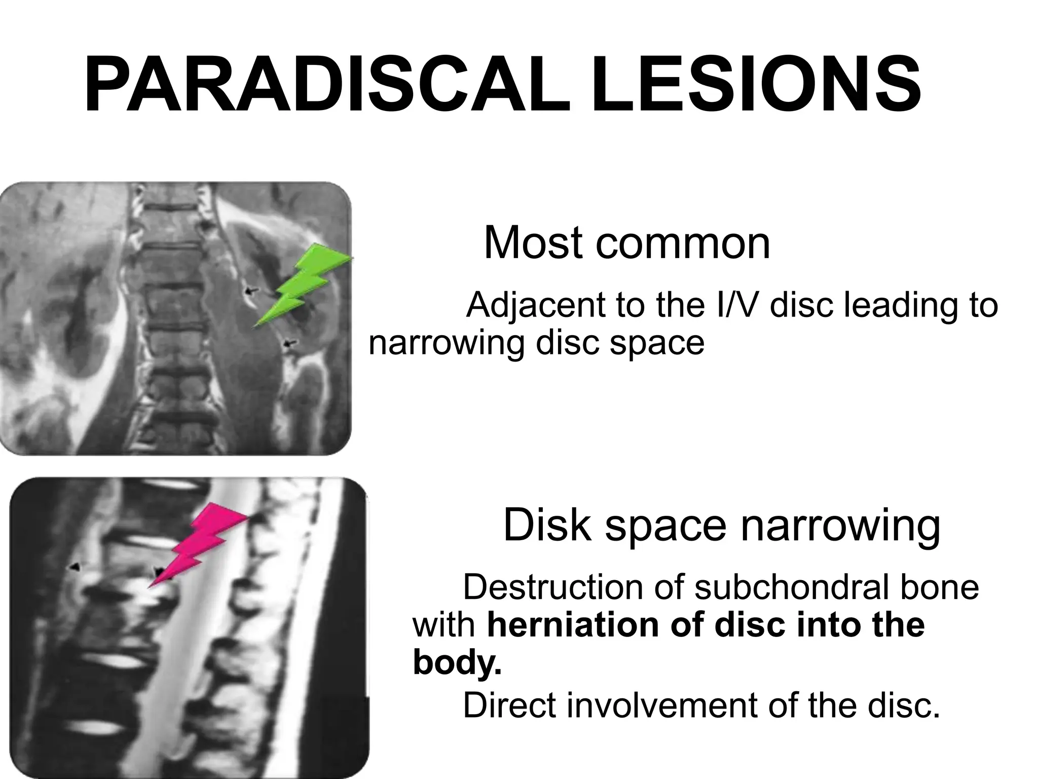 Pott's Spine. (Tuberculosis Spine) pptx | PPTX
