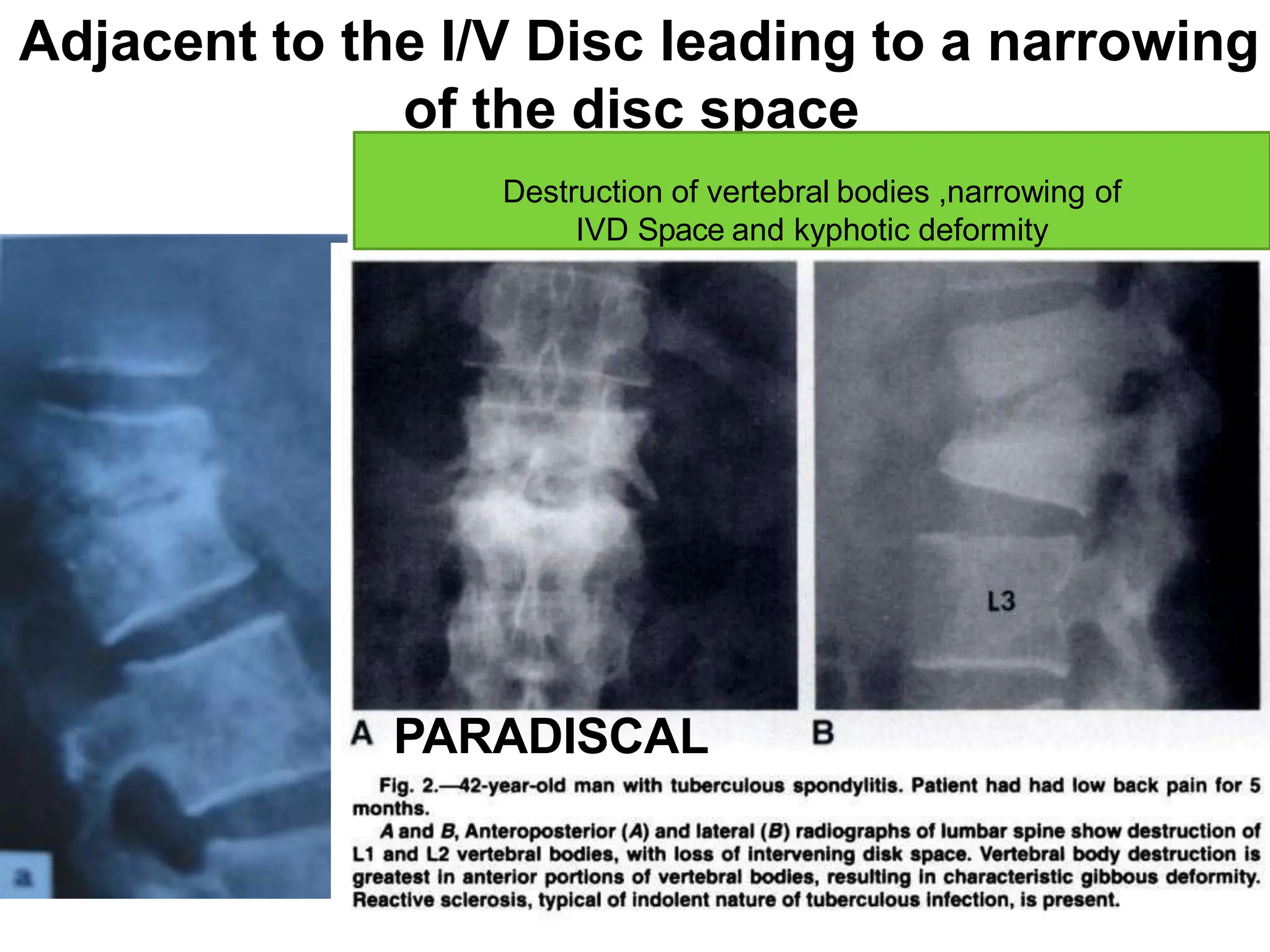 Pott's Spine. (Tuberculosis Spine) pptx | PPTX