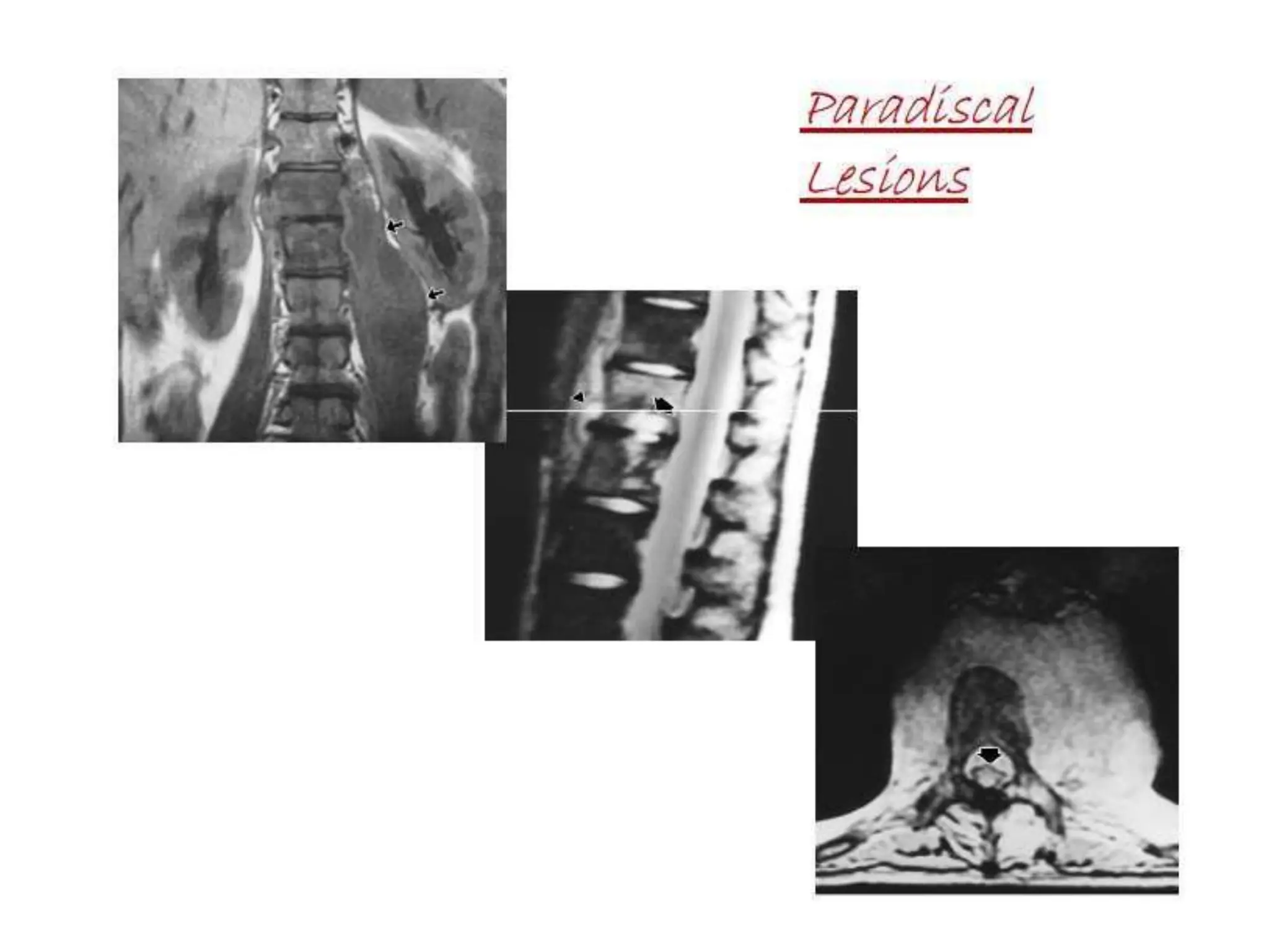 Pott's Spine. (Tuberculosis Spine) pptx | PPTX
