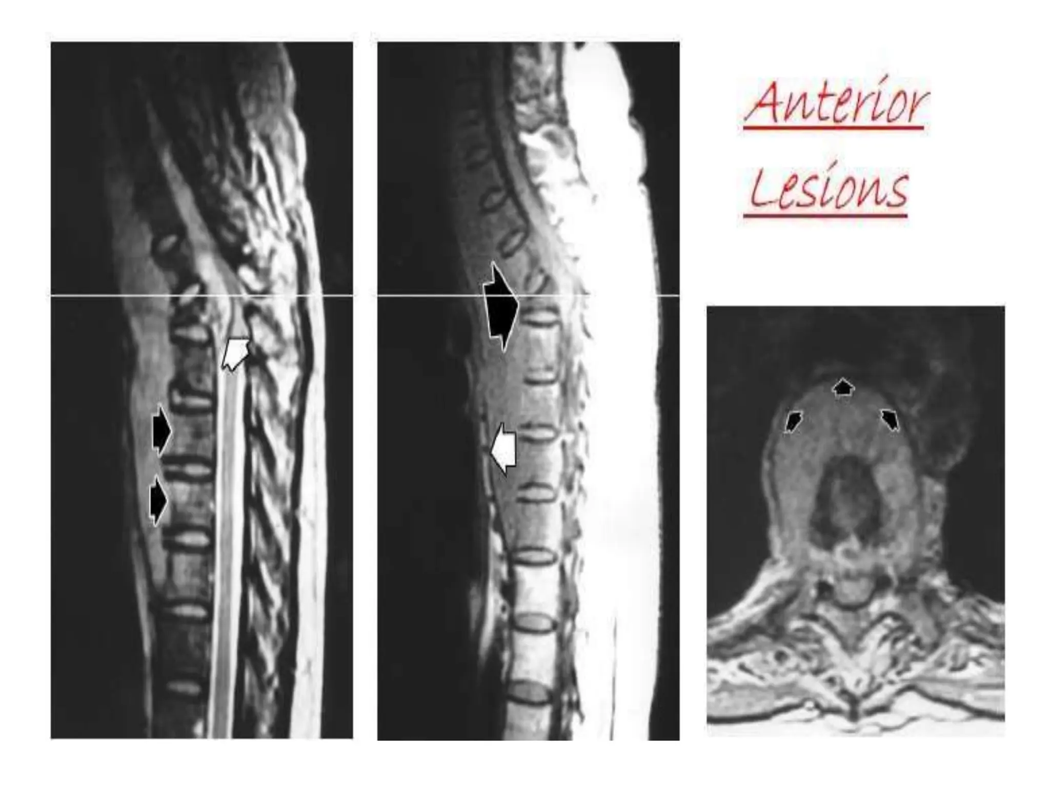 Pott's Spine. (Tuberculosis Spine) pptx | PPTX