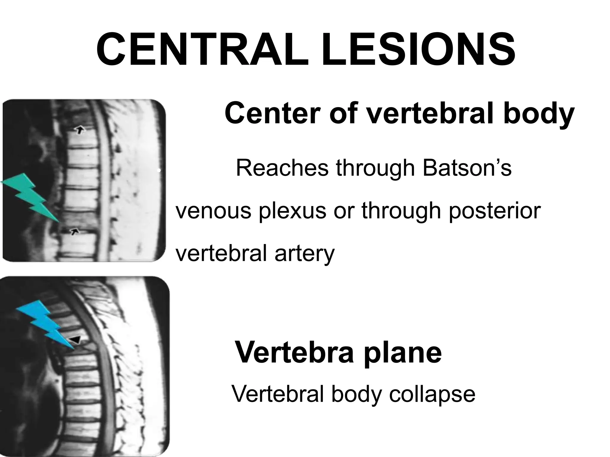 Pott's Spine. (Tuberculosis Spine) pptx | PPTX