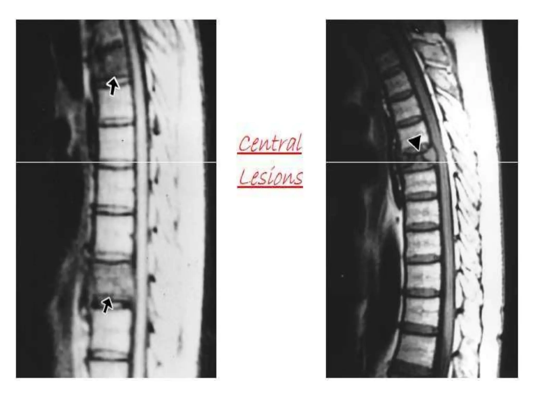 Pott's Spine. (Tuberculosis Spine) pptx | PPTX