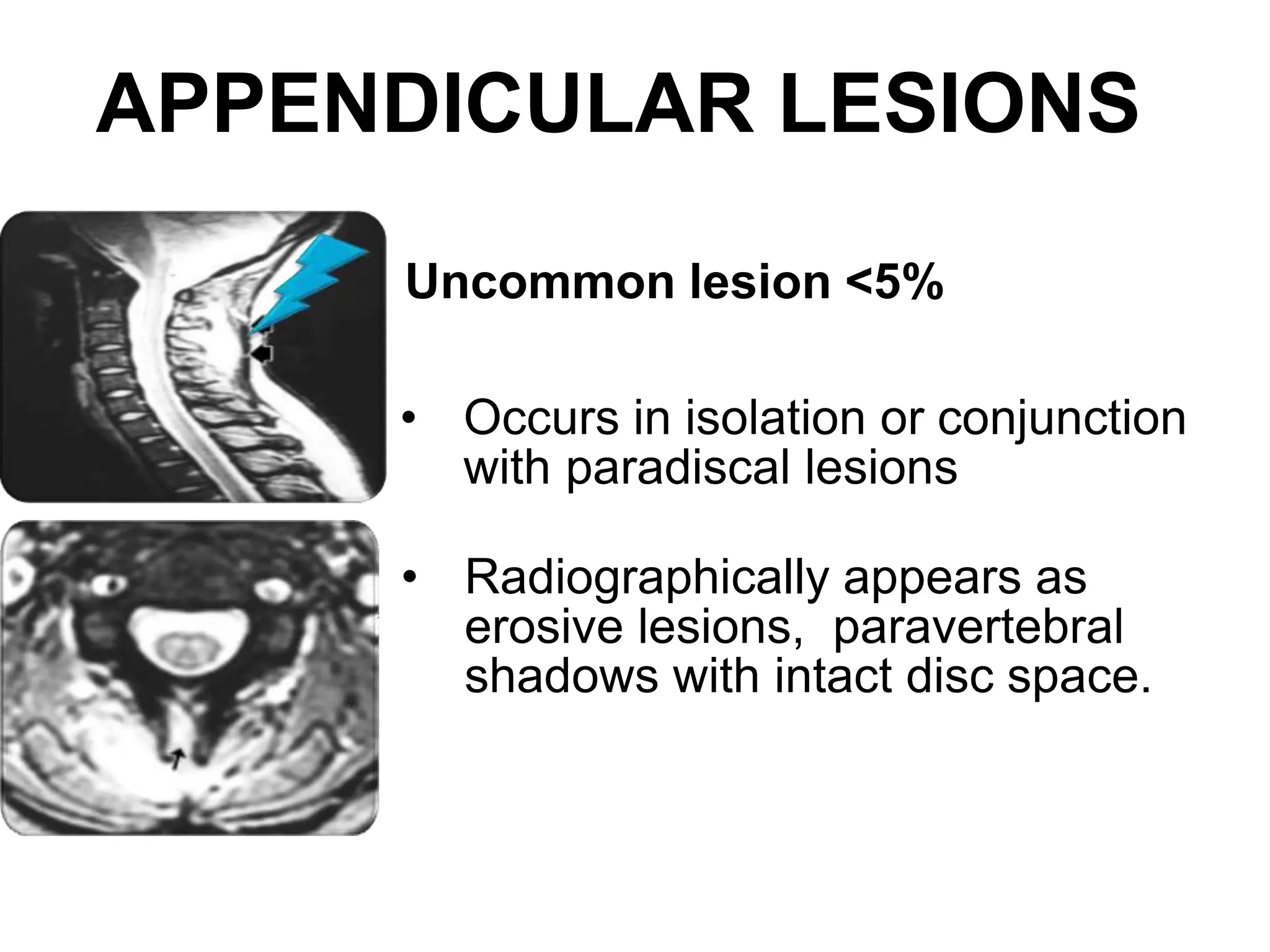 Pott's Spine. (Tuberculosis Spine) pptx | PPTX