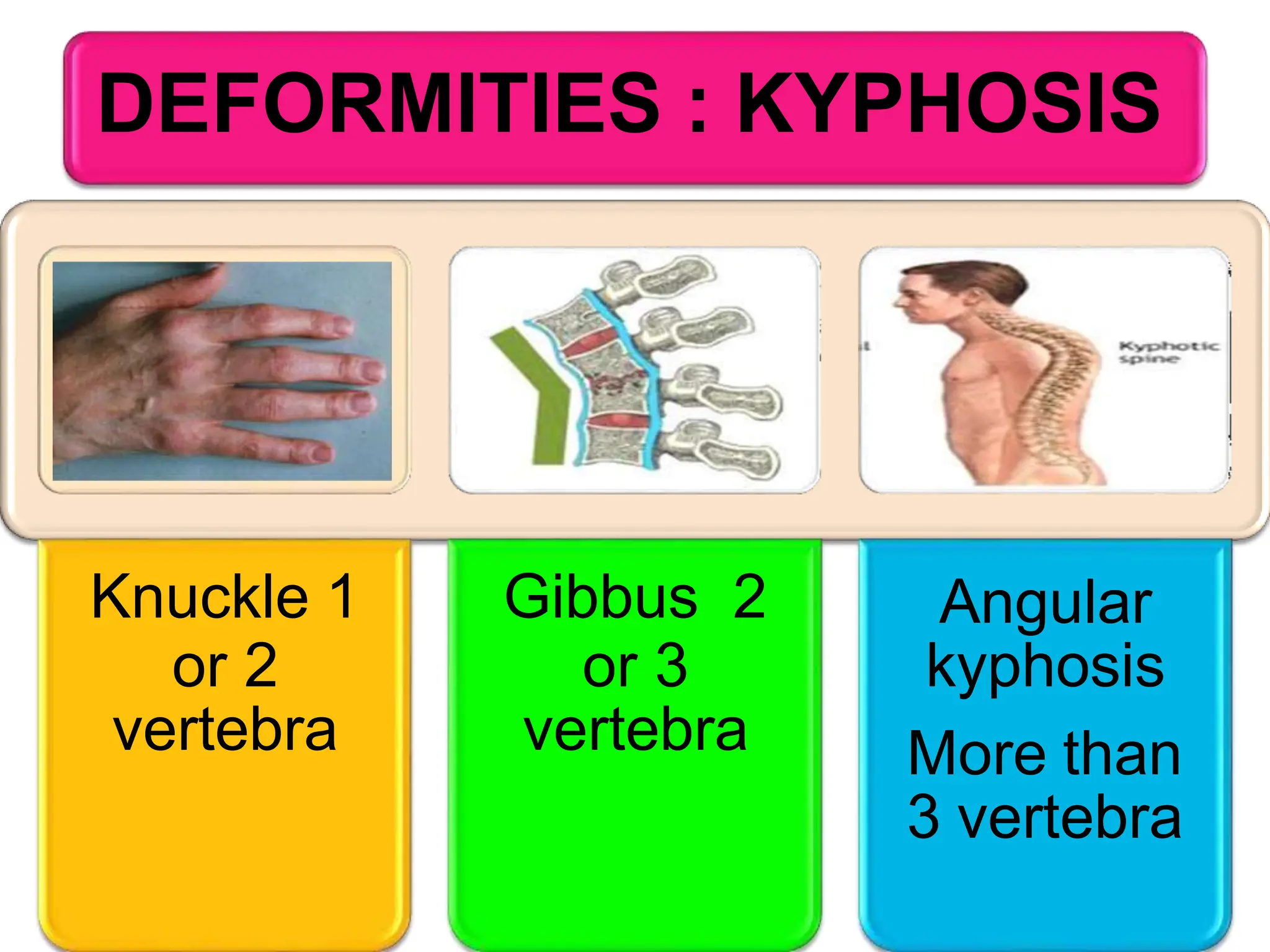 Pott's Spine. (Tuberculosis Spine) pptx | PPTX