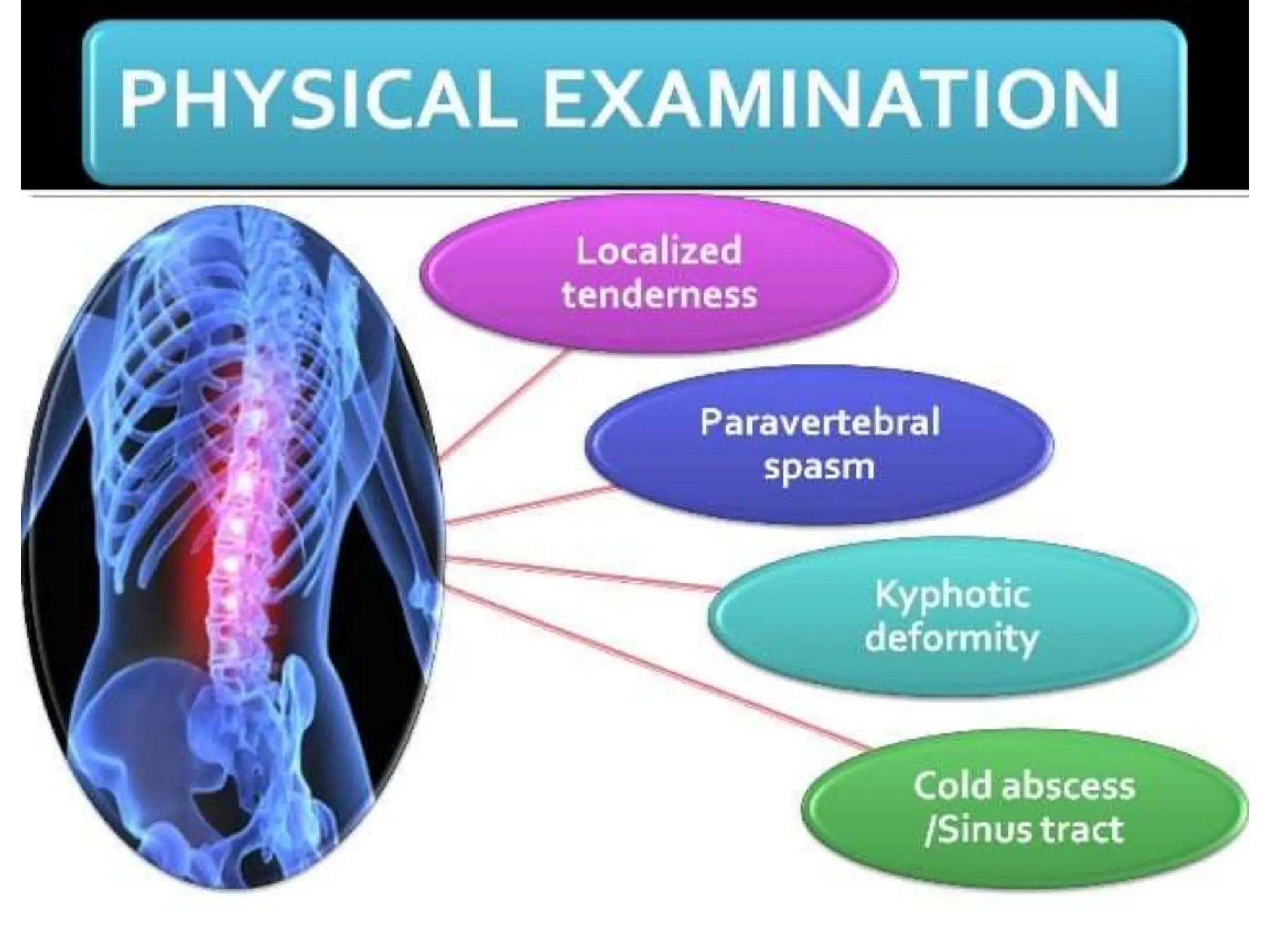 Pott's Spine. (Tuberculosis Spine) pptx | PPTX