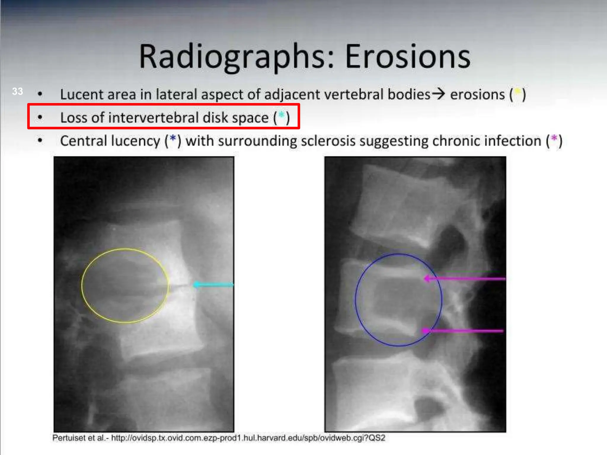 Pott's Spine. (Tuberculosis Spine) pptx | PPTX