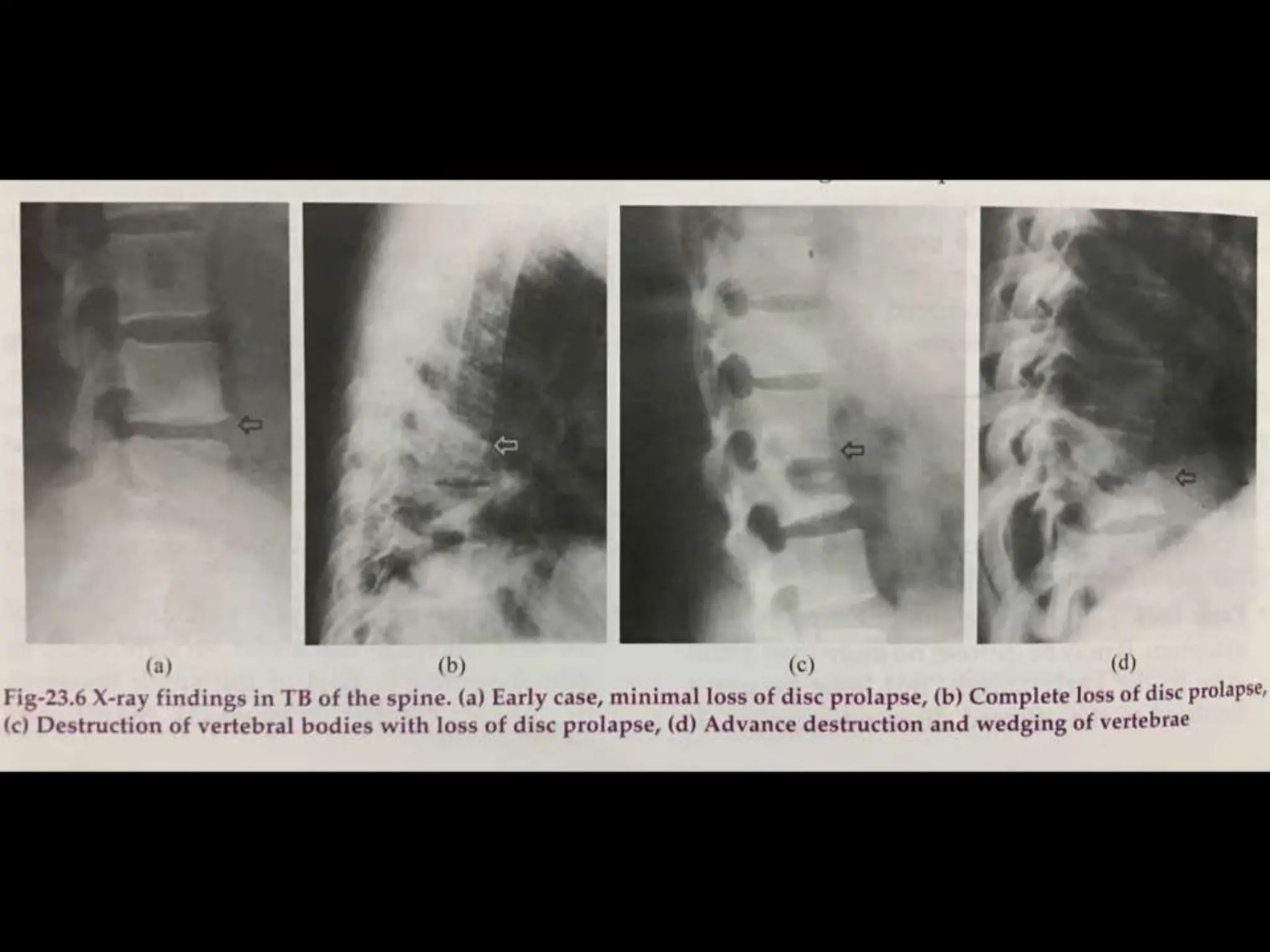 Pott's Spine. (Tuberculosis Spine) pptx | PPTX