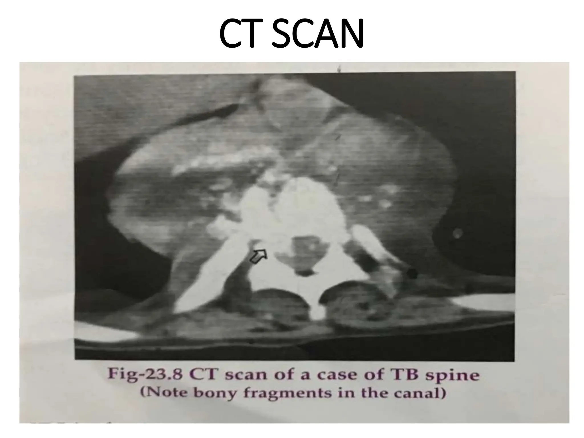Pott's Spine. (Tuberculosis Spine) pptx | PPTX