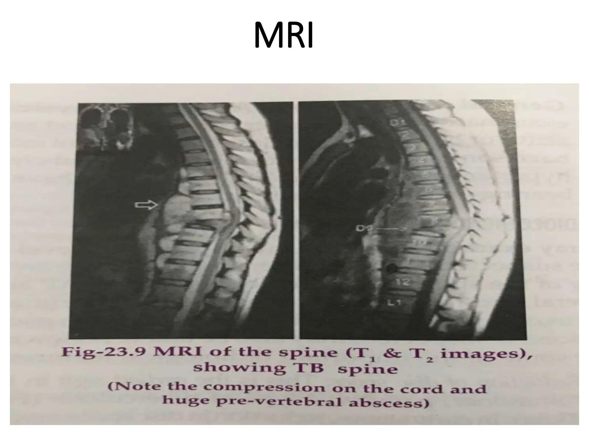 Pott's Spine. (Tuberculosis Spine) pptx | PPTX