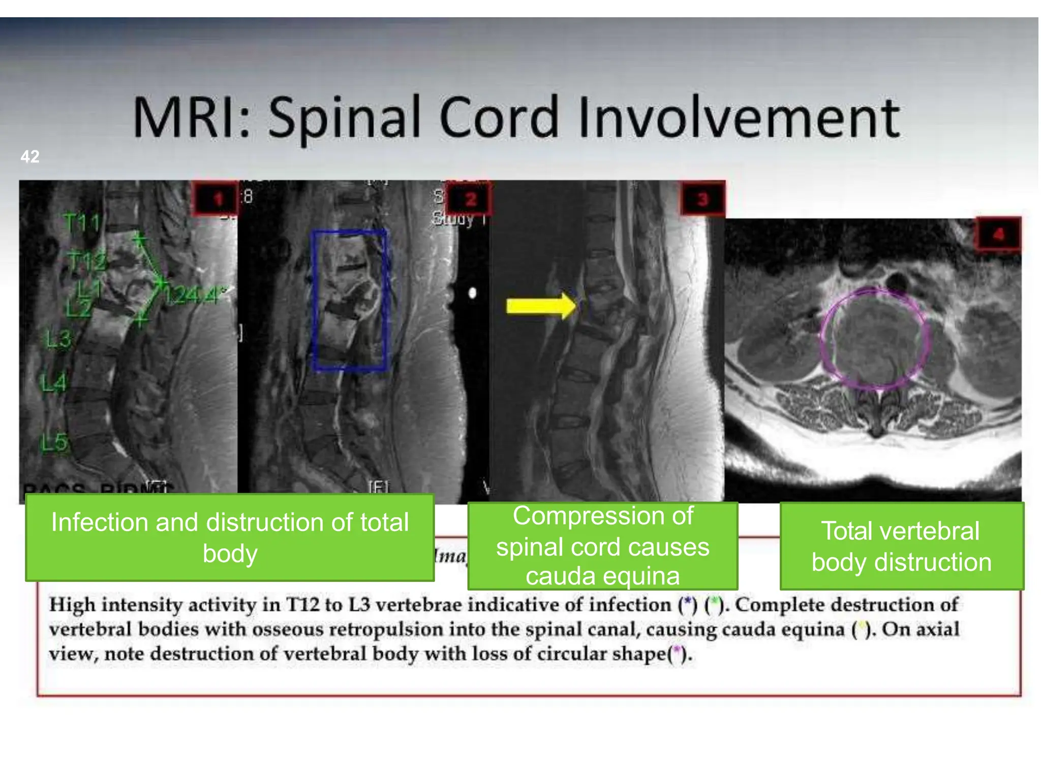 Pott's Spine. (Tuberculosis Spine) pptx | PPTX