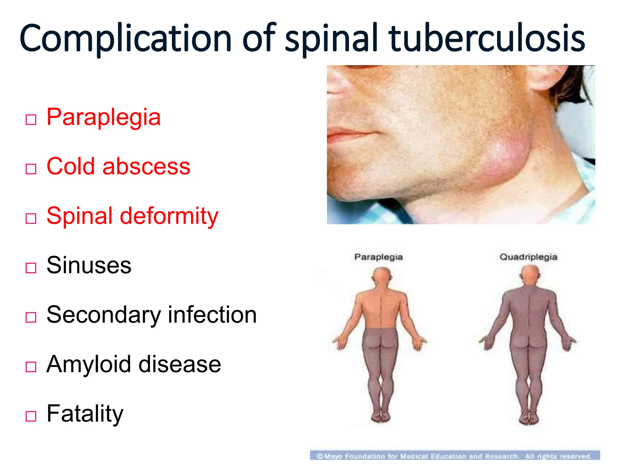 Pott's Spine. (Tuberculosis Spine) pptx | PPTX