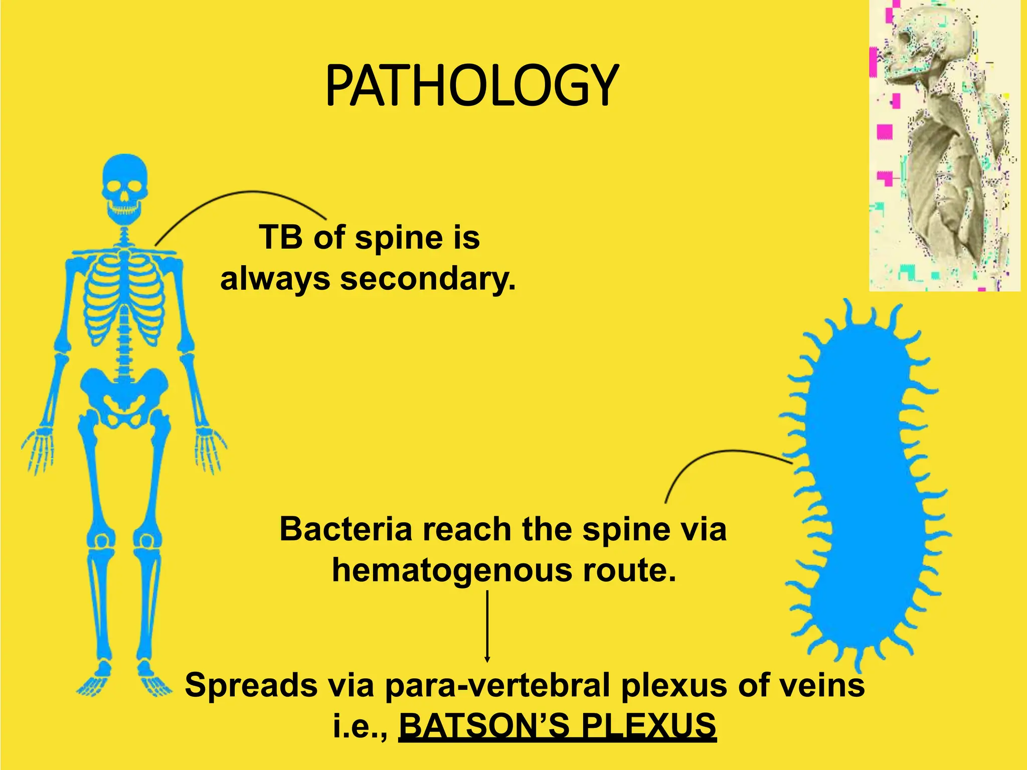 Pott's Spine. (Tuberculosis Spine) pptx | PPTX