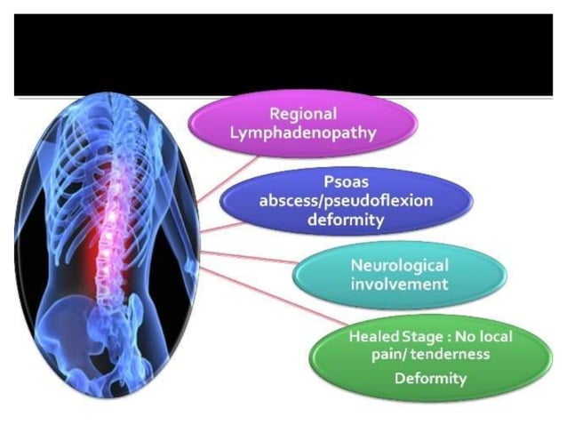 Pott's Spine. (Tuberculosis Spine) pptx | PPTX | Death, Injury, or ...