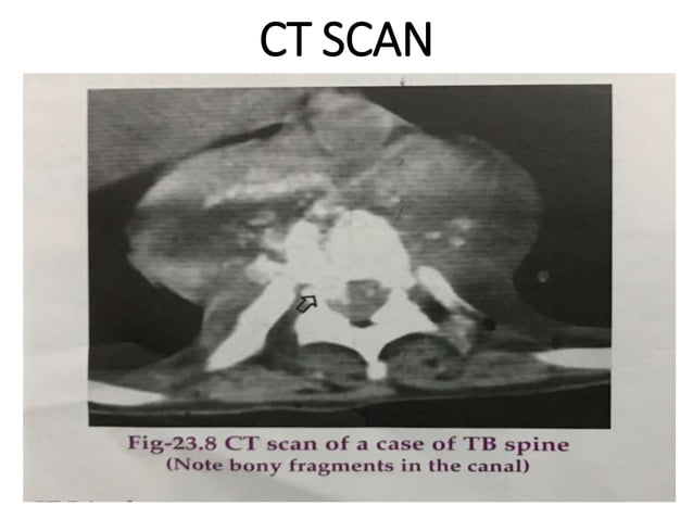 Pott's Spine. (Tuberculosis Spine) pptx | PPTX | Death, Injury, or ...