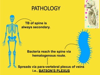 Pott's Spine. (Tuberculosis Spine) pptx | PPTX
