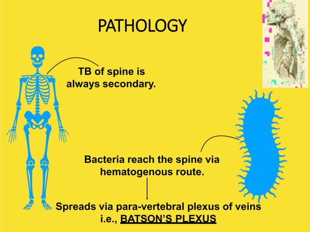 Pott's Spine. (Tuberculosis Spine) pptx | PPTX | Death, Injury, or ...