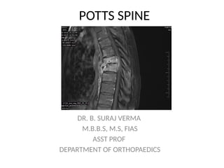 POTTS SPINE.pptx explanation and treatment | PPTX