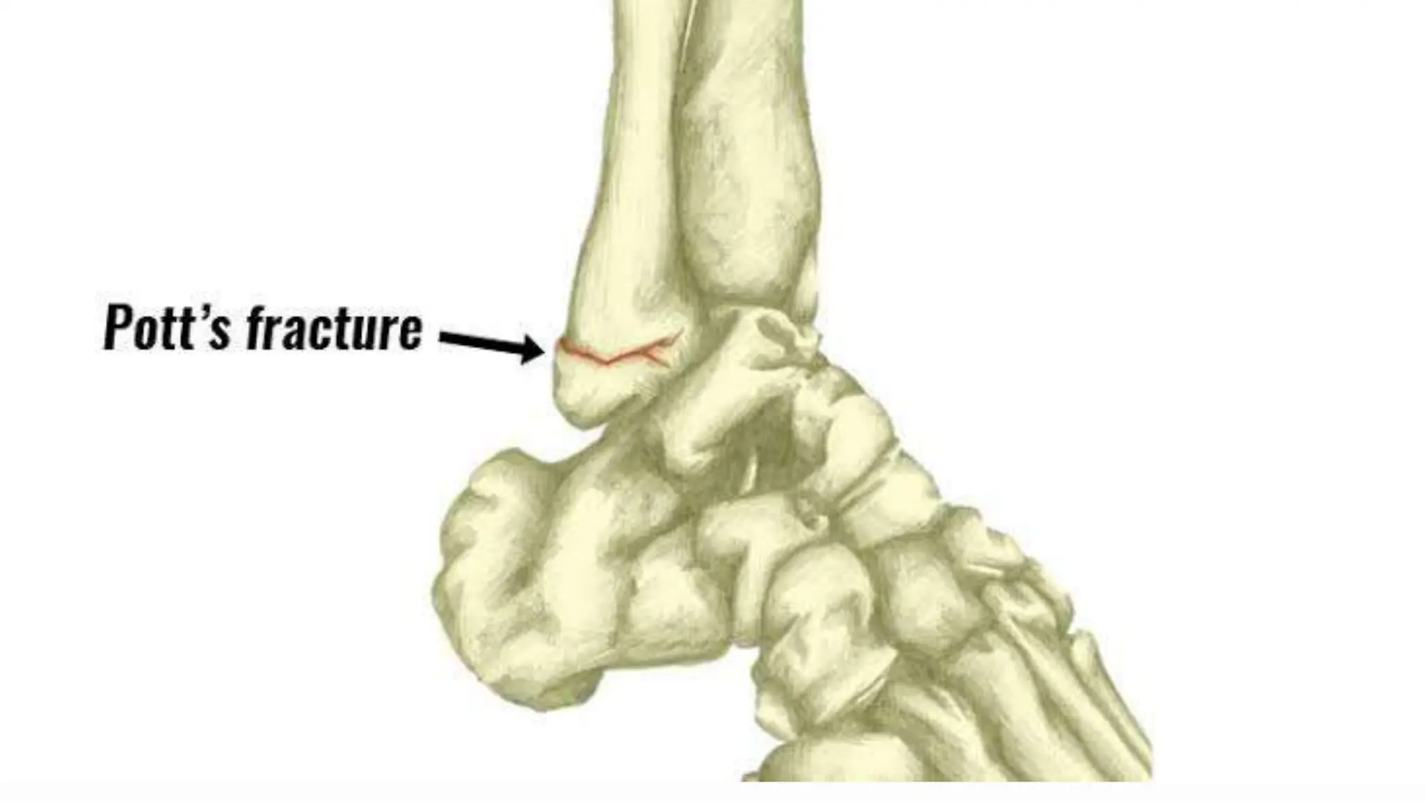 POTTS SPINE /TUBERCULOSIS SPINE (TB SPINE ).pptx