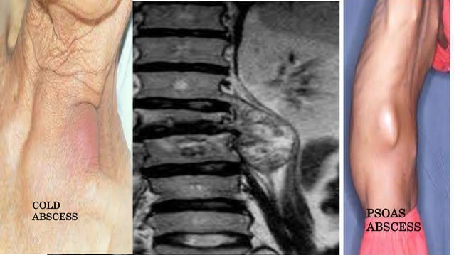 POTTS SPINE /TUBERCULOSIS SPINE (TB SPINE ).pptx | Bone and Joint ...