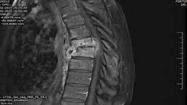 POTTS SPINE /TUBERCULOSIS SPINE (TB SPINE ).pptx | Bone and Joint ...