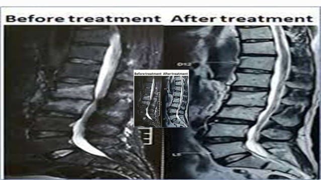POTTS SPINE /TUBERCULOSIS SPINE (TB SPINE ).pptx | Bone and Joint ...