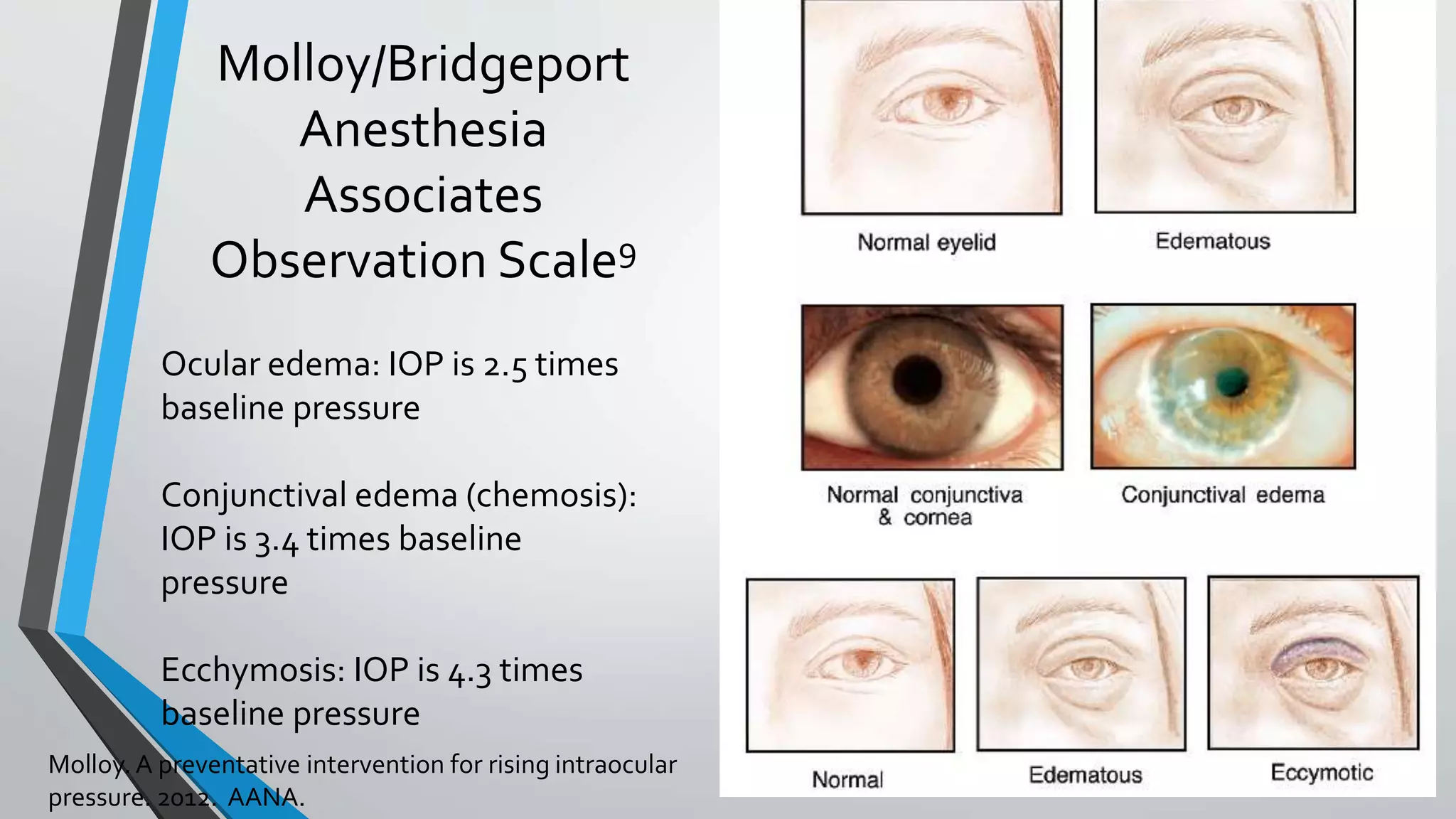 Postoperative Vision Loss Kathy Alwon Pptx
