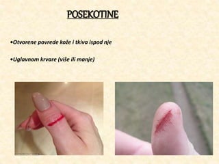 Povrede kože i prva pomoć | PPTX