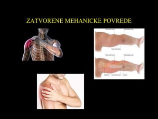 Povrede, mehanicke povrede | PPT