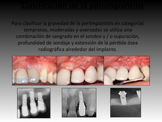 Tratamiento de las lesiones perimplantarias | ODP