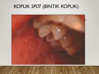Edukasi tentang power point Campak rubella_ppt | PDF