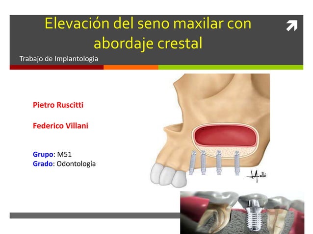 ELEVACION DEL SENO DEL MAXILAR | PPT