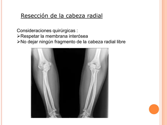 FRACTURA DE CABEZA DE RADIO Y CUPULA RADIAL