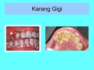 Power poin Penyuluhan gigi.ppt