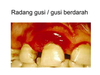 Power poin Penyuluhan gigi.ppt