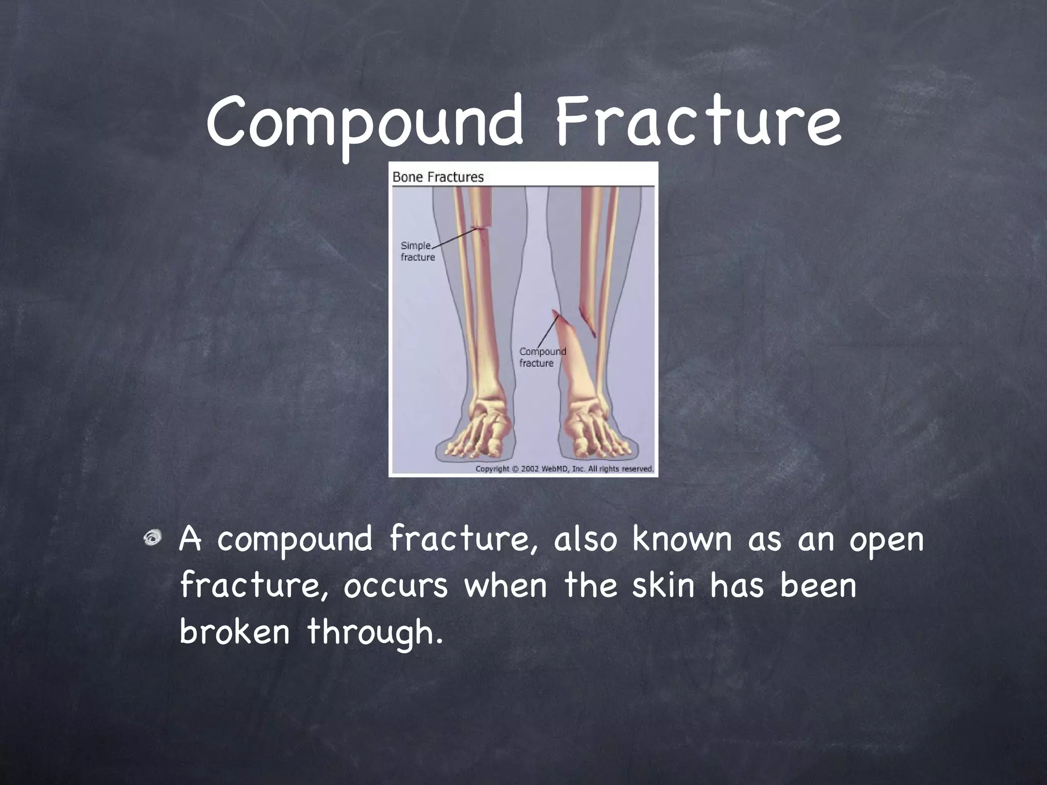 Comminuted, Simple, and Compound Fractures | PPT