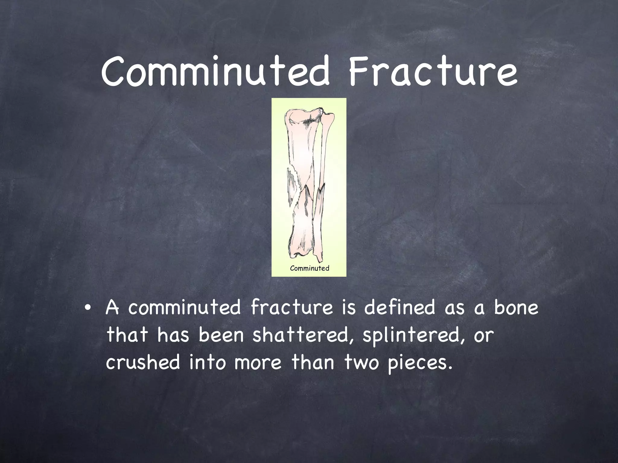 Comminuted, Simple, and Compound Fractures | PPT