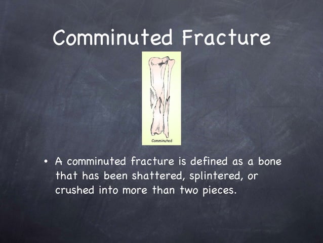 Comminuted, Simple, and Compound Fractures | PPT